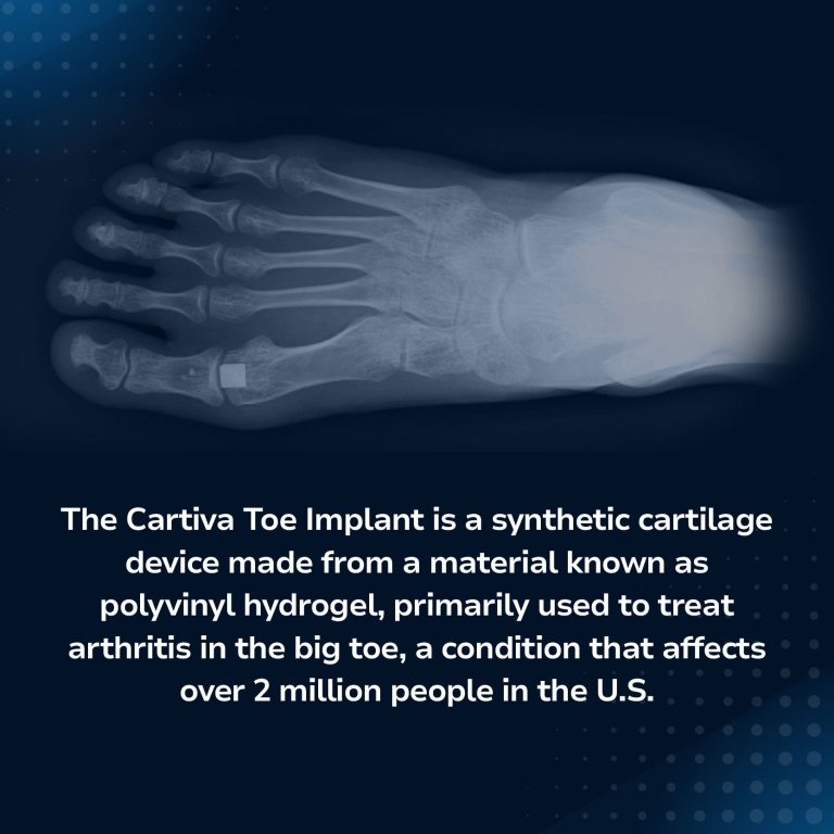 Cartiva Implant – Tort Experts