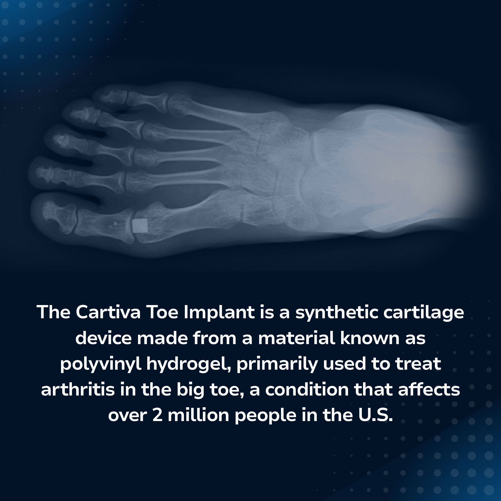 Cartiva Implant – Tort Experts